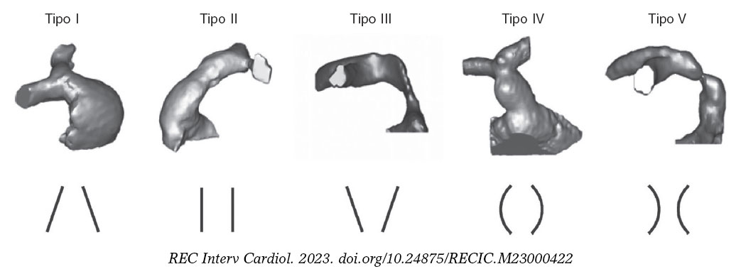 Implante valvular pulmonar percutáneo en tracto de salida nativo: ¿ha llegado el momento?