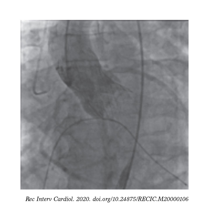 TAVI en indicaciones especiales