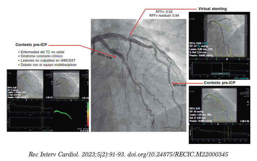 RFF vascular basada en angiografía coronaria cuantitativa 3D: evidencia ...