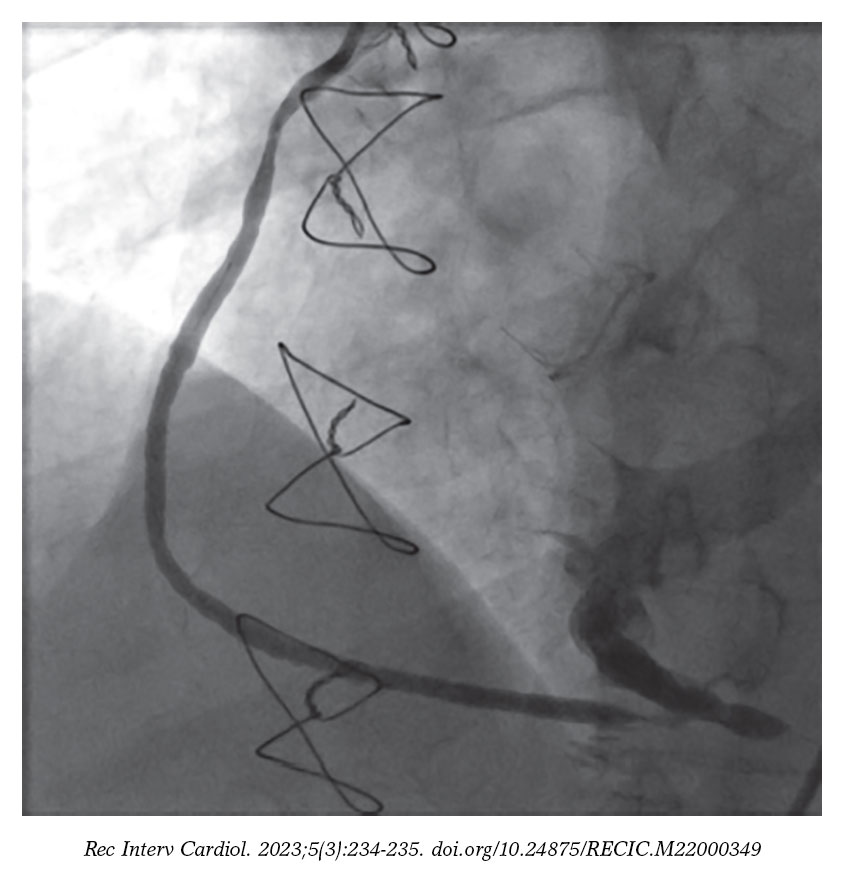Angina temprana después de cirugía de revascularización coronaria
