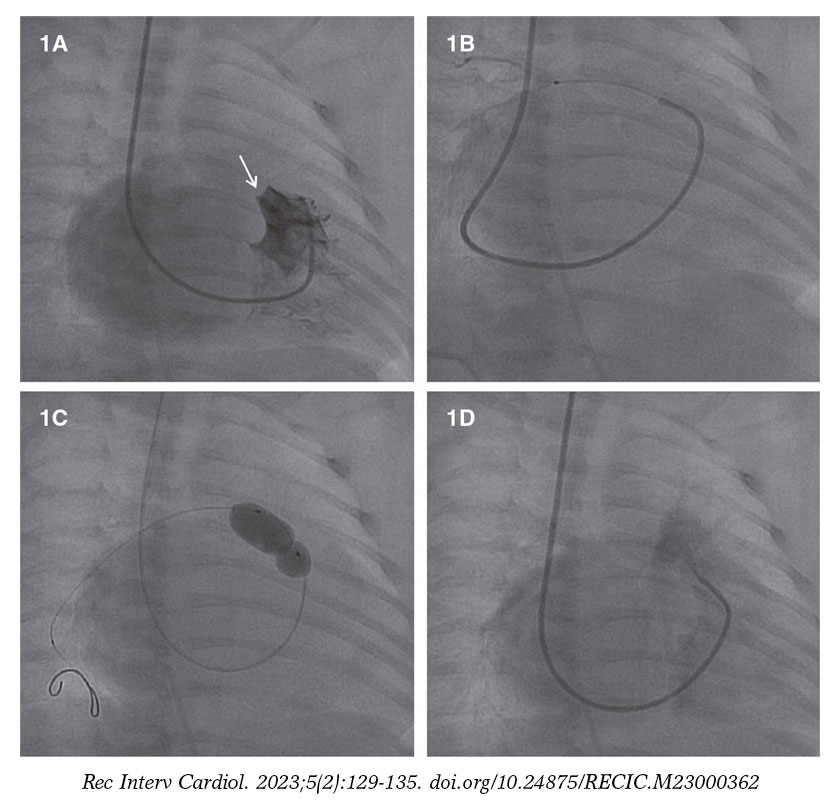 Perforación percutánea de la válvula pulmonar en recién nacidos ...