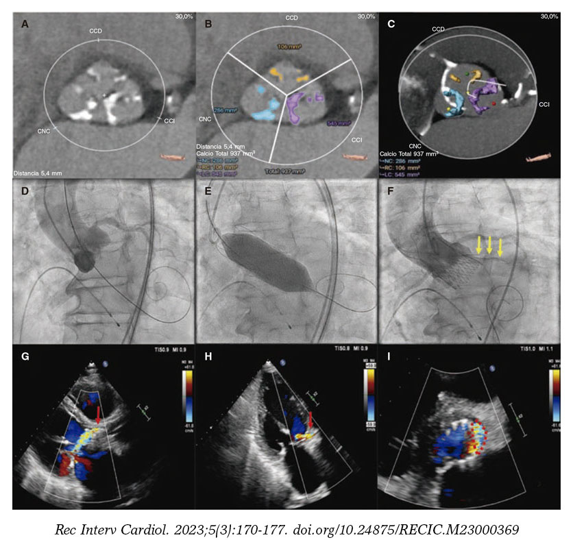 Fuga paravalvular tras implante de ACURATE neo y neo2: estudio ...