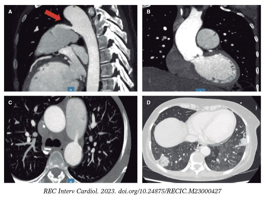 Presentación de ductus como embolia sistémica y pulmonar
