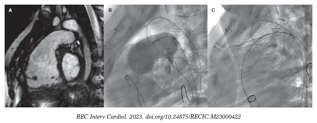 Implante valvular pulmonar percutáneo en tracto de salida nativo: ¿ha llegado el momento?