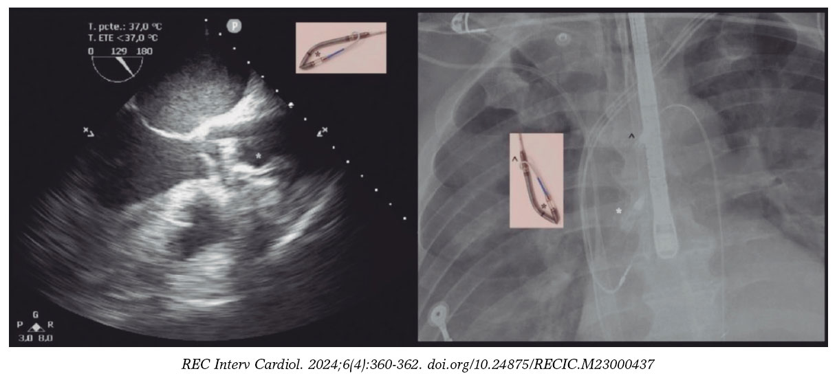 Rizar el rizo en el soporte con Impella