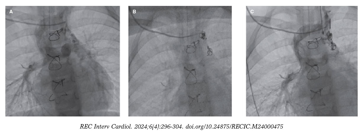 Tratamiento de colaterales tras cirugía de Glenn y su impacto en ...