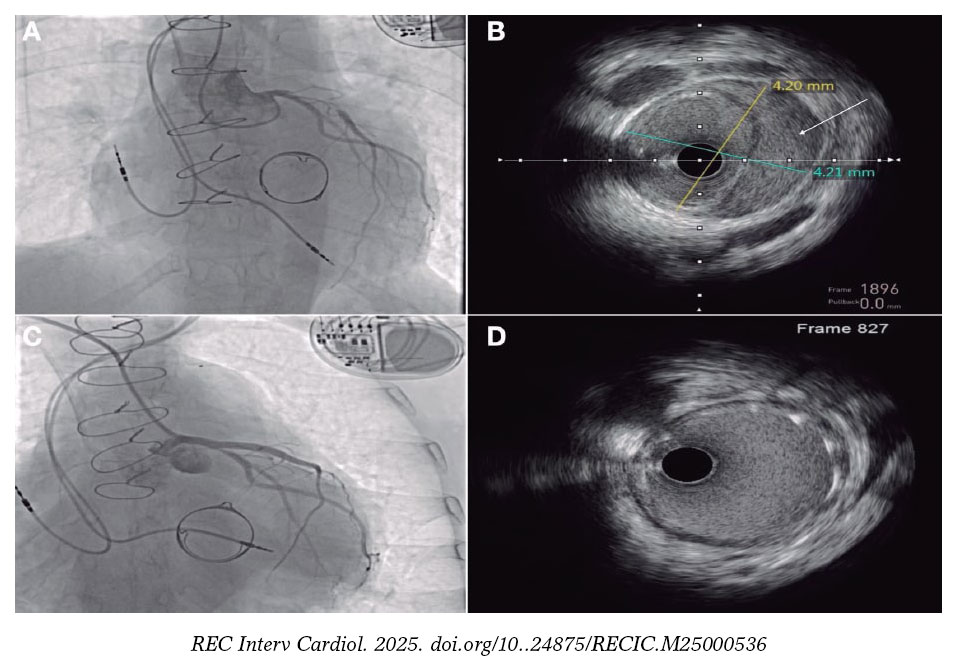 Valve-in-valve mitral con septo interauricular gravemente calcificado
