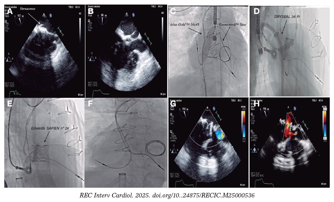 Valve-in-valve mitral con septo interauricular gravemente calcificado