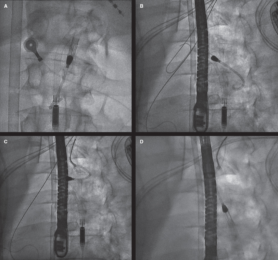 Rizar el rizo en el soporte con Impella