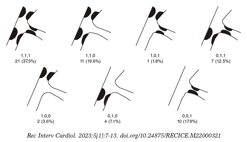 Long-term effectiveness of drug-coated balloon in the side branch ...