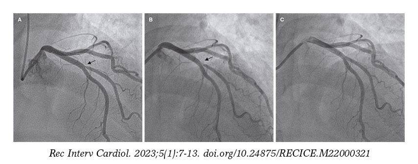 Long-term effectiveness of drug-coated balloon in the side branch ...