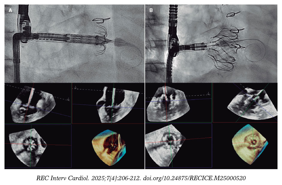 Case series of transcatheter tricuspid EVOQUE valve implantation in ...