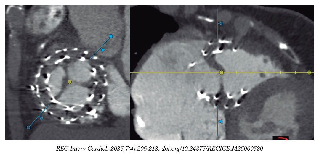Case series of transcatheter tricuspid EVOQUE valve implantation in ...