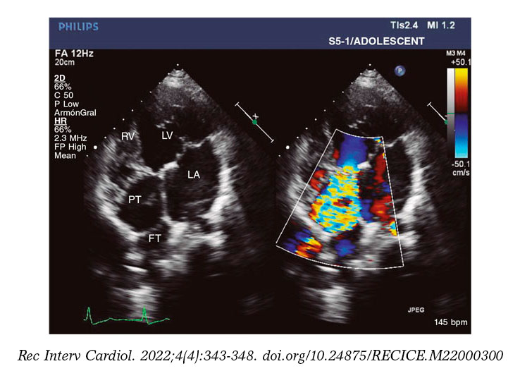 Percutaneous closure of fistula between pulmonary trunk and Fontan ...