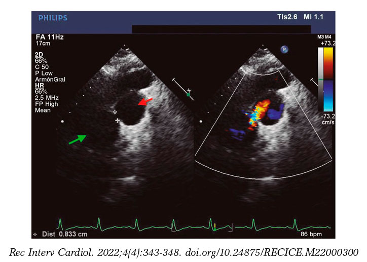 Percutaneous closure of fistula between pulmonary trunk and Fontan ...