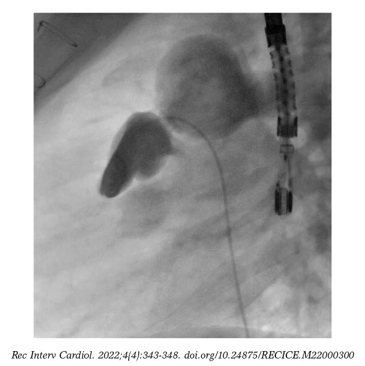 Percutaneous closure of fistula between pulmonary trunk and Fontan ...
