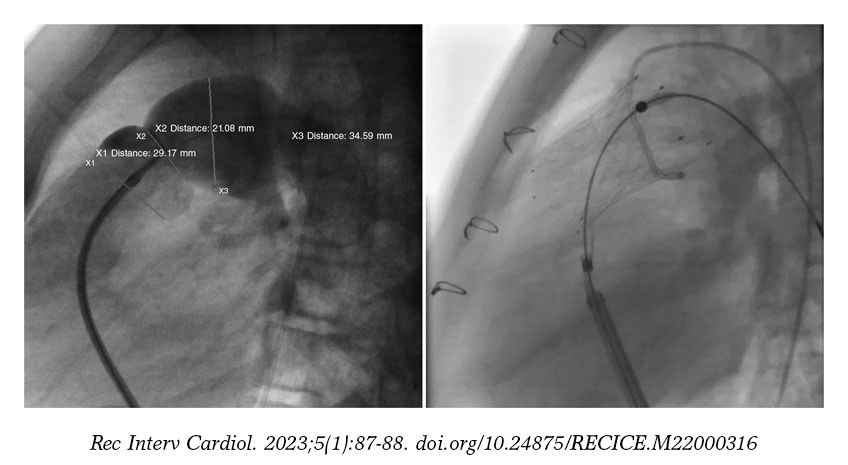 Pulmonary artery perforation due to off-label stent