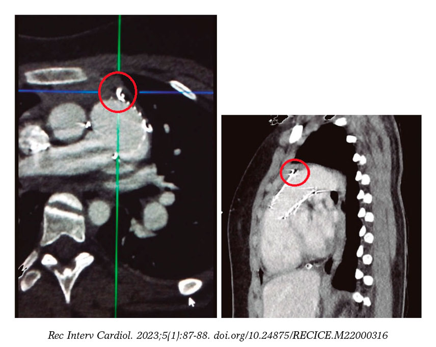 Pulmonary artery perforation due to off-label stent