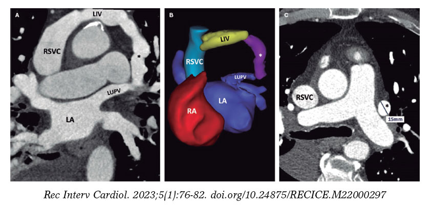 Percutaneous treatment of partial anomalous pulmonary venous connection ...