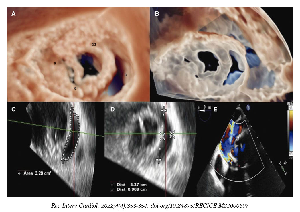 Giant mitral paravalvular leak closure using double transapical access