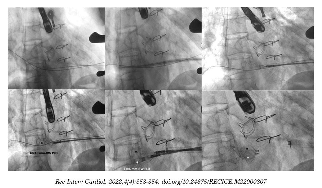 Giant mitral paravalvular leak closure using double transapical access