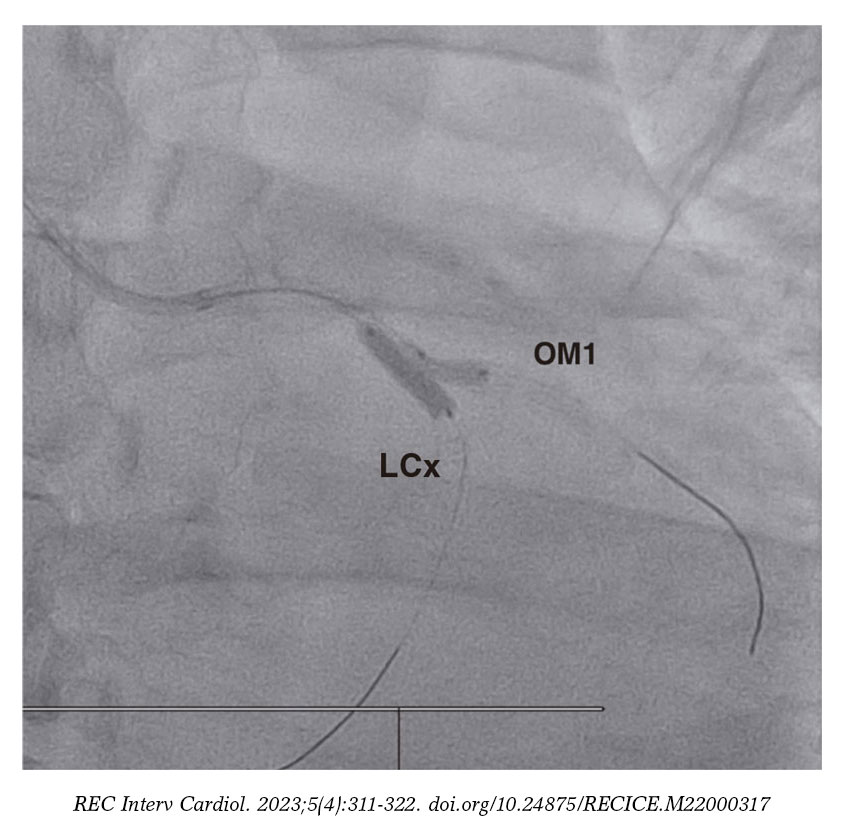 Impella-Clip: a secure and effective strategy in cardiogenic shock due ...