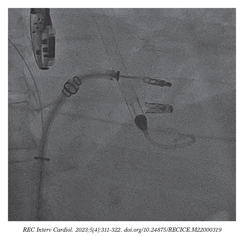 Impella-Clip: a secure and effective strategy in cardiogenic shock due ...