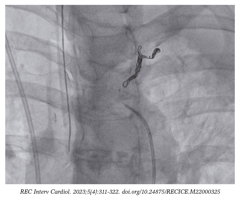 Massive hemoptysis. Selective embolization of bronchial artery-left ...