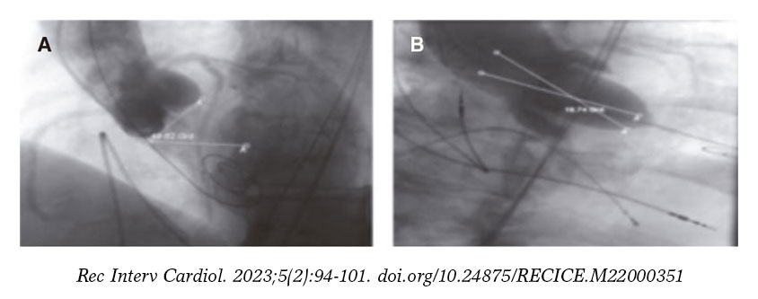 Transcatheter aortic valve implantation using Evolut PRO versus SAPIEN 3 valves: a randomized ...