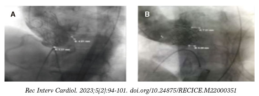 Transcatheter aortic valve implantation using Evolut PRO versus SAPIEN 3 valves: a randomized ...