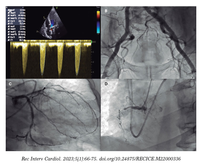 Emergency transcatheter aortic valve implantation in cardiogenic shock ...