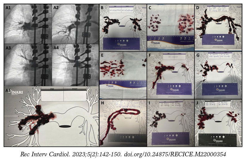 Early experience with the FlowTriever thrombectomy system to treat ...