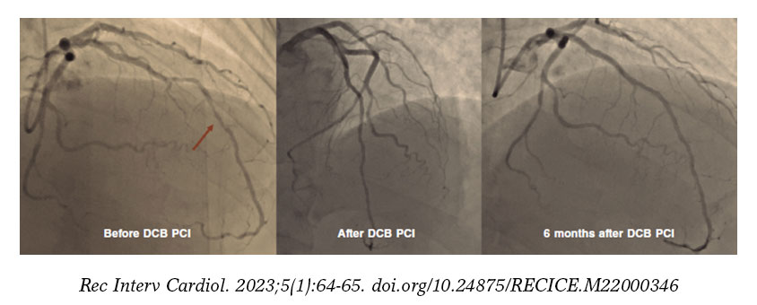 Debate. Drug-coated balloons for de novo coronary artery lesions ...