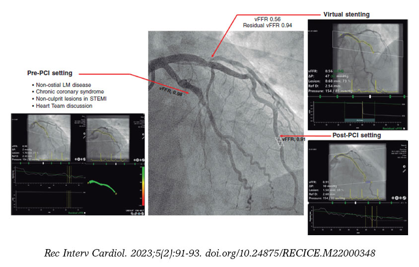 3D quantitative coronary angiography based vessel FFR: clinical ...