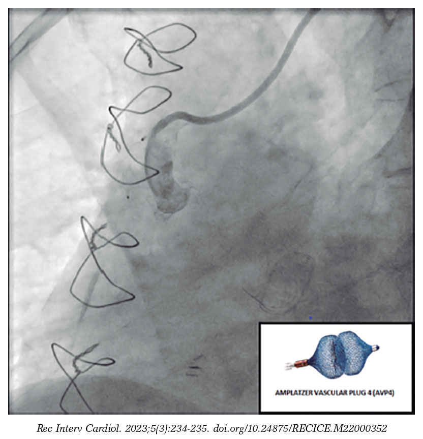 Early angina after coronary artery bypass grafting