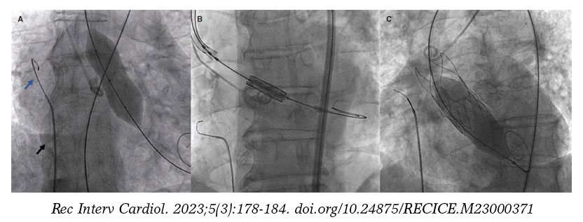 Right atrium: a good ally in left ventricular pacing during ...