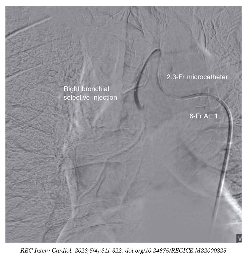Massive hemoptysis. Selective embolization of bronchial artery-left ...