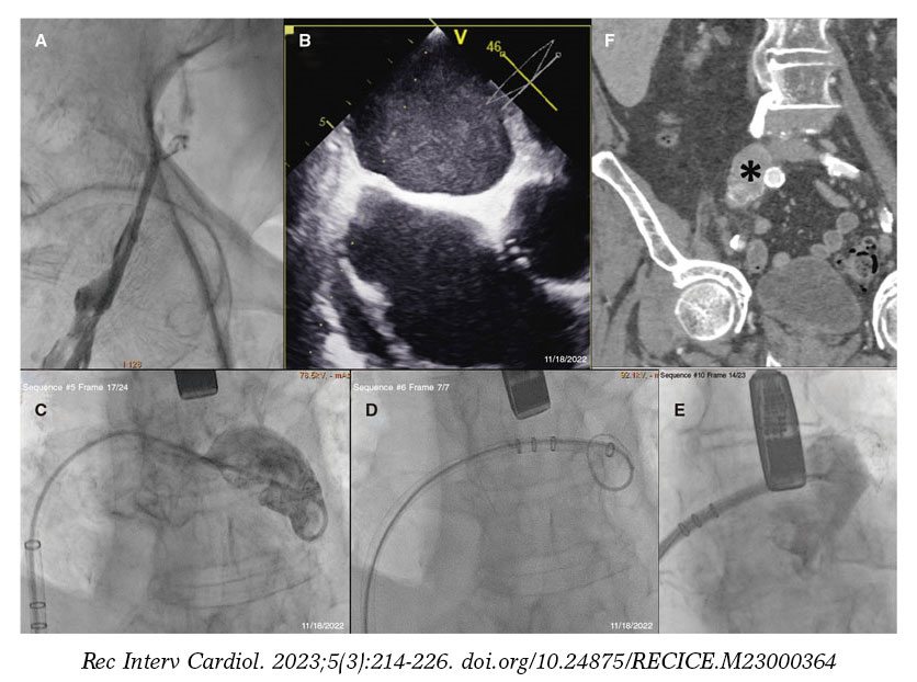 Complex venous disease in transcatheter left atrial appendage closure