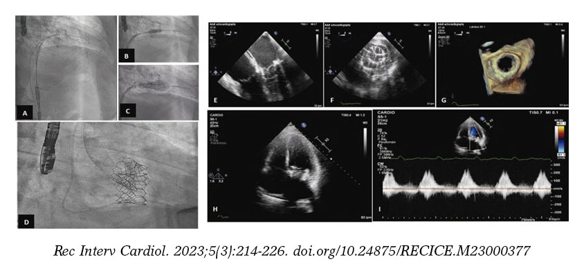 Transfemoral valve-in-MAC implantation due to severe radiation-induced ...
