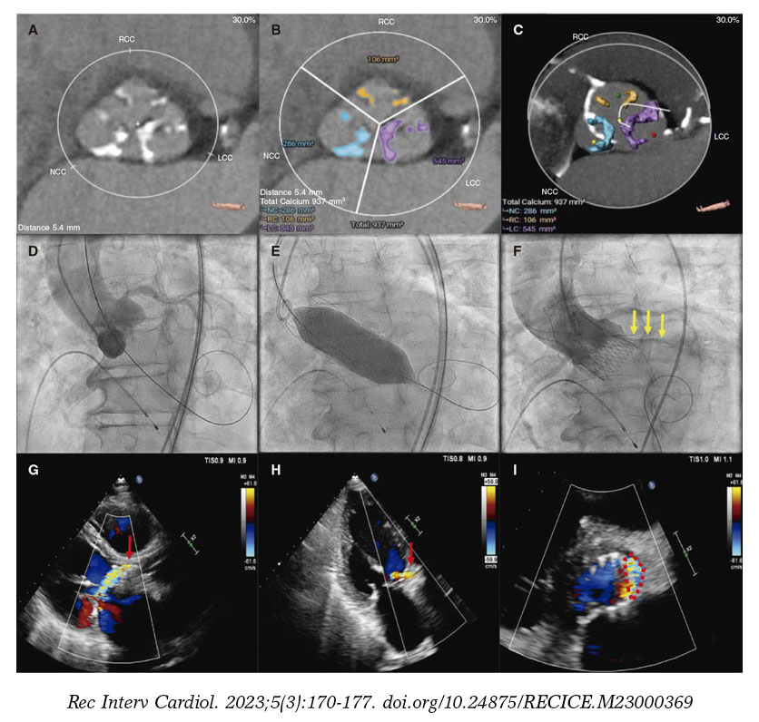 Paravalvular leak with ACURATE neo and neo2: a comparative study with ...