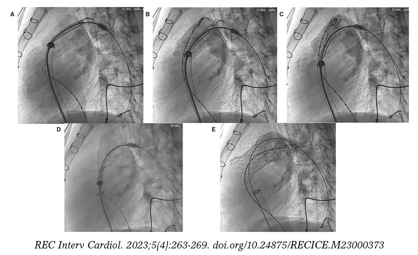 Initial experience with the new percutaneous pulmonary self-expandable ...