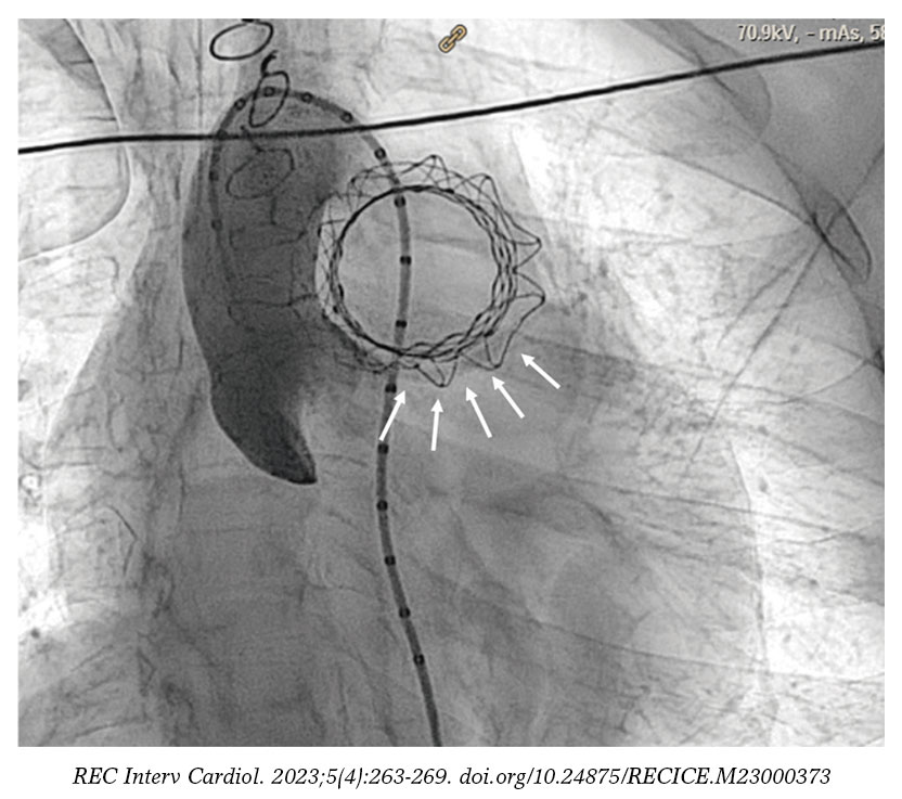 Initial experience with the new percutaneous pulmonary self-expandable ...