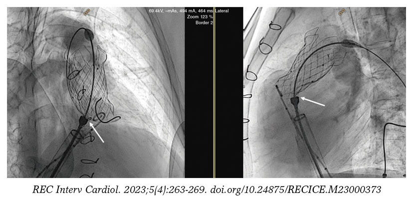 Initial experience with the new percutaneous pulmonary self-expandable ...
