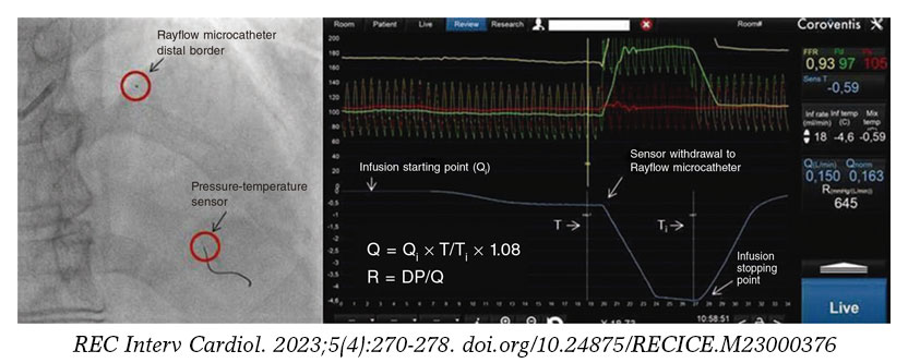 Thermodilution assessment of vasoreactivity and microvascular function ...