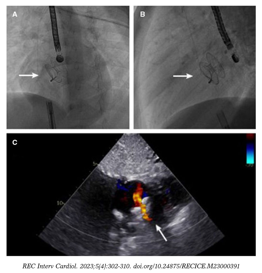 Atrial flow regulator and atrial septostomy in pediatric pulmonary ...