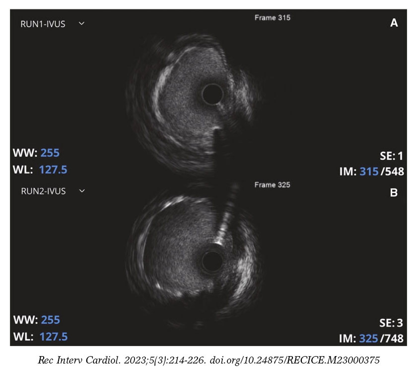 Syphilitic aortitis as a rare cause of coronary ostial stenosis