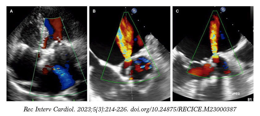 Transcatheter closure of aorto-left atrial fistula