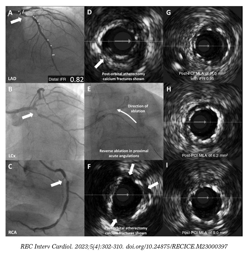 Co-registration assisted 3-vessel orbital atherectomy in de novo ...