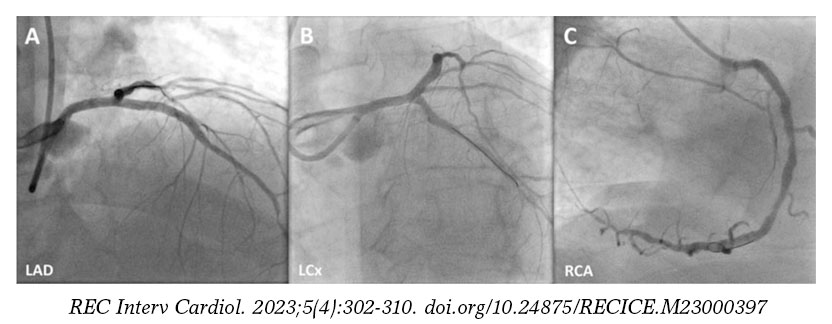 Co-registration assisted 3-vessel orbital atherectomy in de novo ...