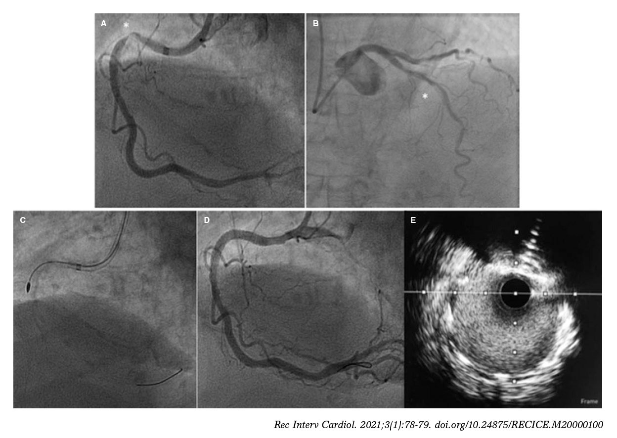 Left main coronary artery perforation after rotational atherectomy